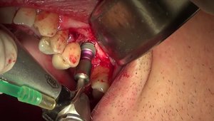 Transcrestal Sinus Floor Augmentation with Simultaneous Implant Placement | VuMedi