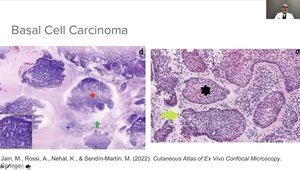 Ex Vivo Confocal Microscopy and its Current Use in Dermatologic Practice | VuMedi