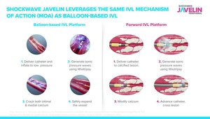 Shockwave Javelin Device Overview & Case Review with Dr. Corl | VuMedi