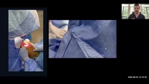 Vacuum-Assisted Bone Debrider in Prosthetic Joint Infection (Expedited 2 Stage) | Vumedi