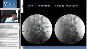 The Lumbar Plexus and Transpsoas Approach: An Anatomic and ...