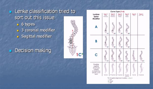 Lenke classification and selection of fusion levels | VuMedi