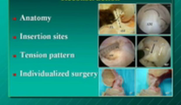 Anatomic Double Bundle ACL Reconstruction | VuMedi