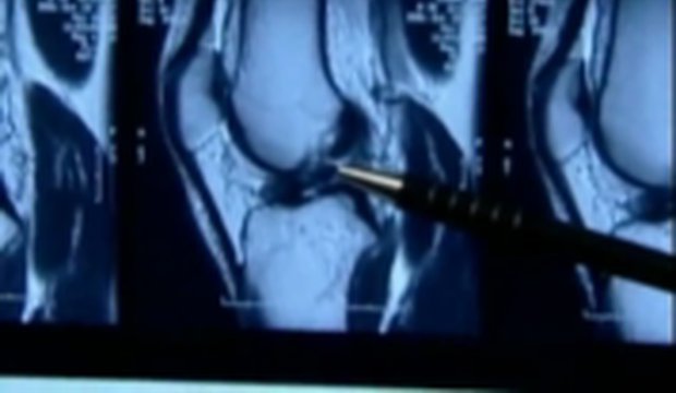 ACL Reconstruction using a Hamstring Autograft | VuMedi