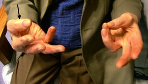 Opponensplasty: Flexor Carpi Radialis to Abductor Pollicis Brevis ...