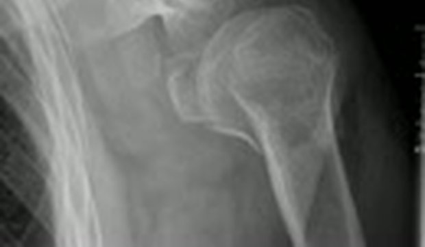 ORIF of Proximal Humerus Fracture using Locked Plating | VuMedi