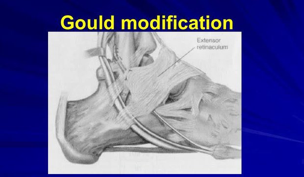 Brostrom Ligament Repair for Ankle Instability | VuMedi