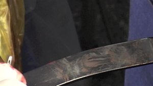 Pectoralis Major Repair - Cortical Button Technique | Vumedi