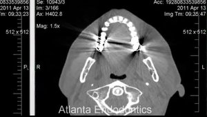 ENT physician diagnoses failed root canal | Vumedi