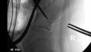 Pelvic Fixation Using Sacral Alar Iliac Fixation Technique | VuMedi