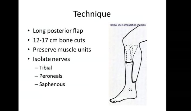 Transtibial Amputation Update | VuMedi