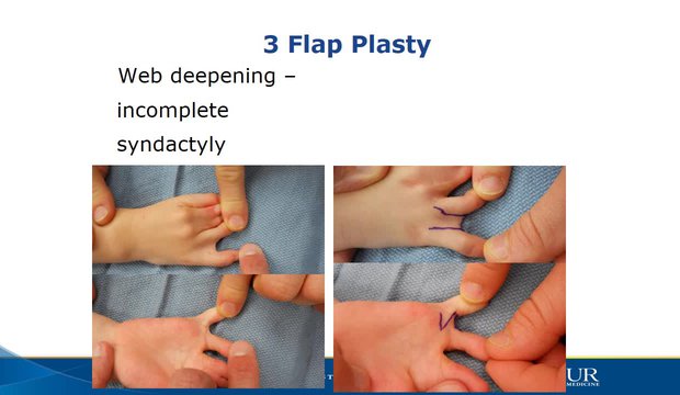 Local Flaps for Hand Coverage | VuMedi