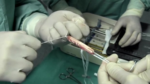 All-Inside ACL Reconstruction with Quadrupled Semitendinosus with ...