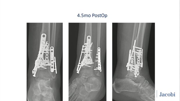 Tibial Pilon Fracture External Fixator
