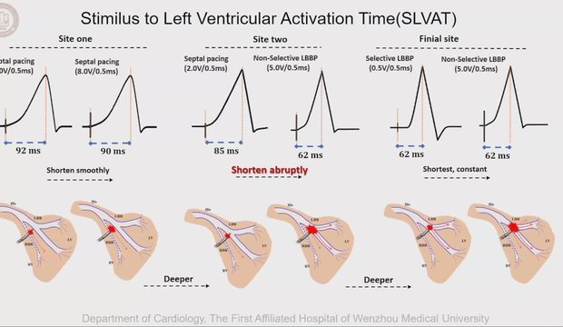 Left Bundle Branch Pacing - Huang Technique and Conduction System ...