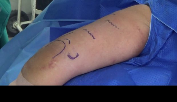 Posterior MIPO for humerus diaphyseal fractures with extra-articular ...