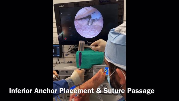 Arthroscopic Shoulder Portal Placement for Pan-Labral Repair | Vumedi