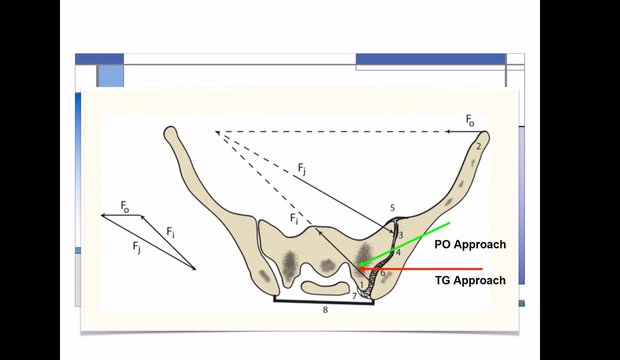 Retrospective Analysis of Sacroiliac Joint (SIJ) Fusions Comparing the ...