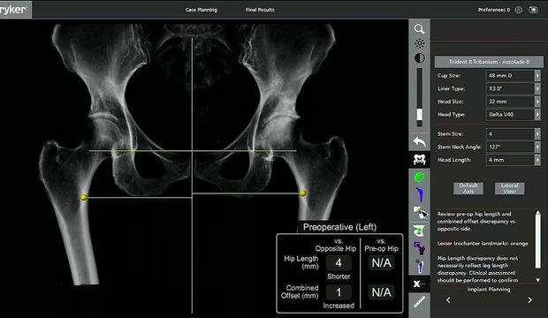 Incorporating Pelvic Tilt Planning in My Total Hips with Mako Total Hip ...