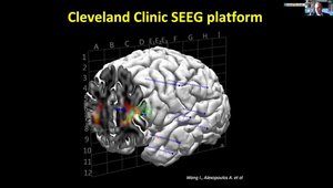 Role of Multimodal Noninvasive Data in SEEG Planning | VuMedi