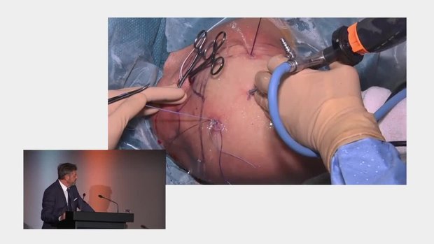 Re-Live Surgery: Arthroscopic Modified Weaver-Dunn Procedure for ...
