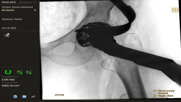 Direct Anterior Total Hip Arthroplasty | Vumedi