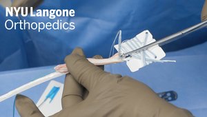 ACL Allograft Reconstruction Augmented with a Reinforced Bio-inductive ...