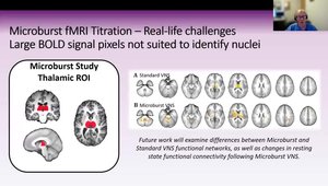 Microburst Vagus Nerve Stimulation: Feasibility Study Results | VuMedi