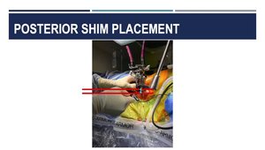 Single-Position Prone Lateral Lumbar Interbody Fusion: Surgical ...