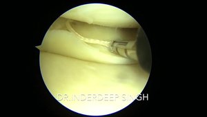 Arthroscopic All inisde medial meniscus repair with linked device ...