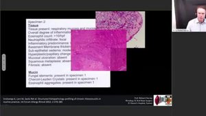 Endotypes and Phenotype in CRS | VuMedi