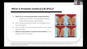 The Efficacy and Safety of Prostatic Urethral Lift as A Minimally ...