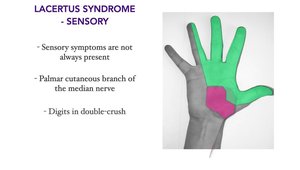 Lacertus Syndrome - Median Nerve Compression in the Elbow | VuMedi