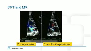 MR and CRT: How to Maximize Roles of CRT and ICD on Secondary MR | Vumedi