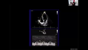 RV Function on 2D Echo | VuMedi