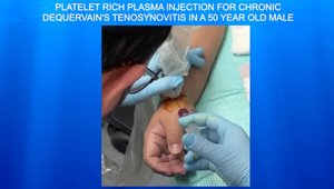 Platelet Rich Plasma Injection for Chronic DeQuervain's Tenosynovitis ...