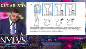 Transverse Tibial Transfer and Advanced Limb Ischemia | Vumedi