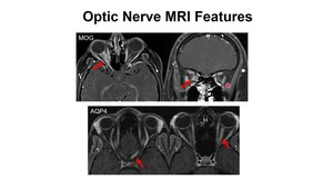 Optic Neuritis: Differential Diagnosis, Clinical Characteristics ...