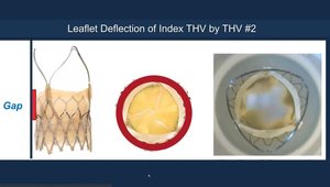 TAVI in TAVI: Current Evidence and How to Do It | Vumedi
