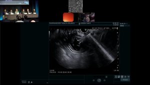Live EUS-Directed Transgastric ERCP (EDGE) in Bypass Patient (Orlando ...