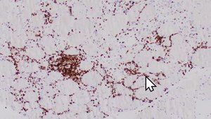 Polymyositis vs. Inclusion Body Myositis, Rare Entities: Differential ...
