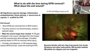 AAO 2025 Insights: Management of Intraocular Foreign Bodies in ...