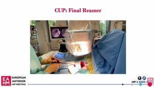 Anterior Path Technique for DAA: Surgical Technique and Results | Vumedi