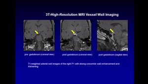Cleveland Clinic Rheumatic Case Studies: 32 y/o Male w/ Inflammatory ...