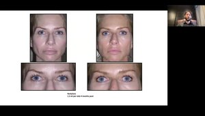 Anatomic Considerations for the Use of Fillers in the Jawline and ...