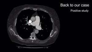 CT Pulmonary Angiogram: Pulmonary Embolism, Case-Based Course | Vumedi