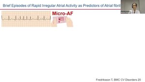 Short Runs of Atrial Fibrillation and Ischemic Stroke: ESUS Latest ...