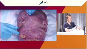 Anatomy and the Masseter: Toxins for TMJ and Masseter Cadaver ...