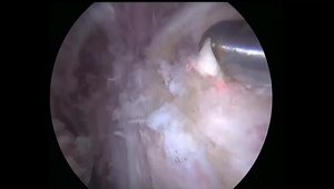 Lower Trap Transfer for Irreparable RCR | Vumedi