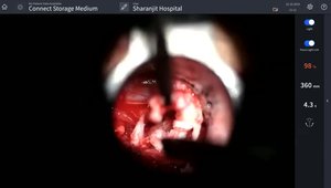 Minimally Invasive Micro-Endoscopic Discectomy: Surgical Demonstration ...